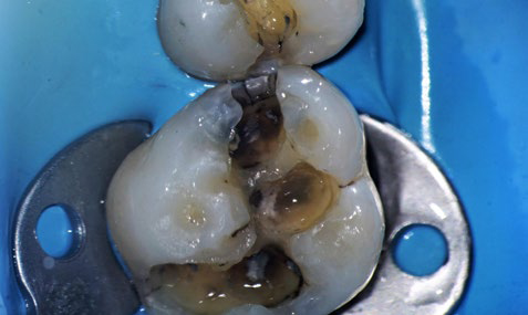 Restorations Blending in Nicely With the Surrounding Tissues - Kuraray ...