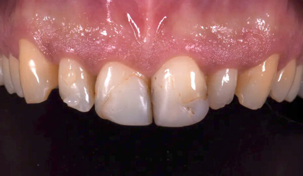 Quick Anterior Restoration in Everyday Practice - Kuraray Dental