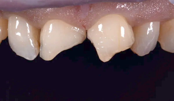 Quick Anterior Restoration in Everyday Practice - Kuraray Dental