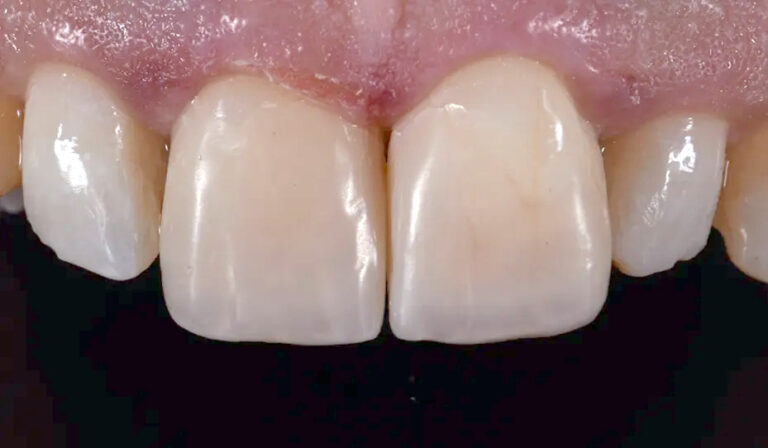 Quick Anterior Restoration in Everyday Practice - Kuraray Dental