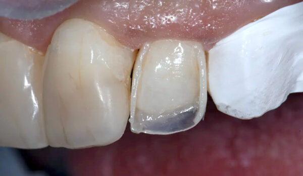Quick Anterior Restoration in Everyday Practice - Kuraray Dental